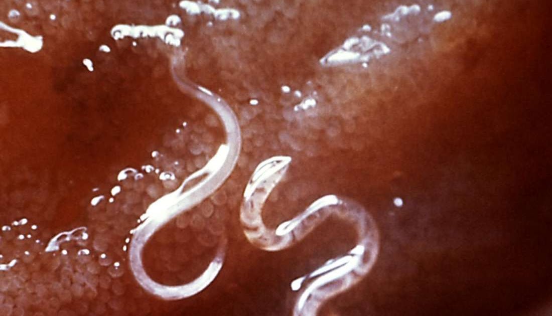 Do Parasites Cause Crohn's Disease, Colitis or Irritable Bowel Disease ...